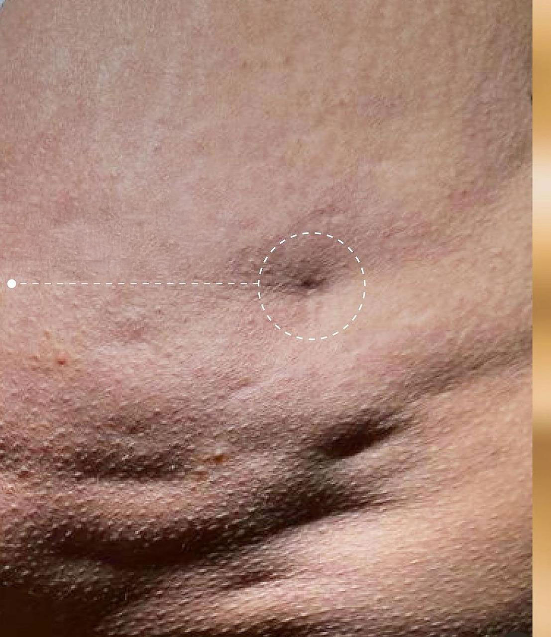 Dr. Jorge Zbeidi | Goldincision - Tratamento de Celulite e Flacidez